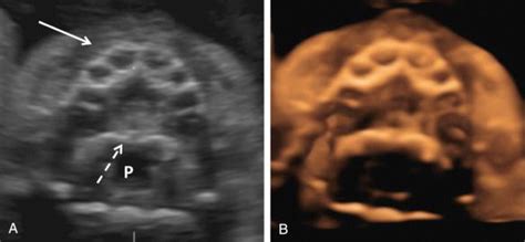 Ultrasound Evaluation Of The Fetal Face And Neck Clinical Tree