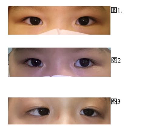 科普｜斜视知多少