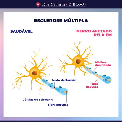 O Que Saber Sobre Desmielinização A Força Motriz Da Esclerose Múltipla