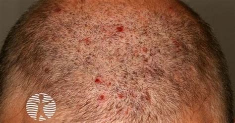 Scalp Folliculitis Image
