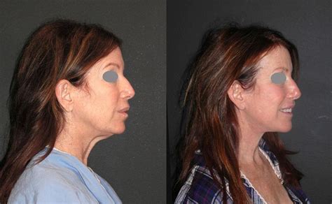 Mini Facelift Procedure Mini Facelifting Artofit