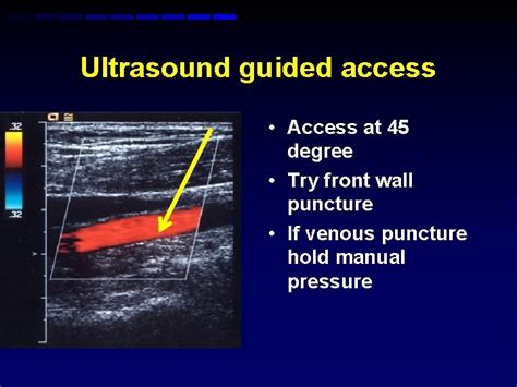 Antegrade Femoral And Retrograde Popliteal Artery Access Aravinda