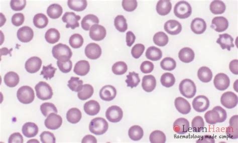 Acanthocytes Learnhaem Haematology Made Simple