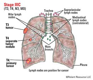 Lung Cancer Staging Illustrations