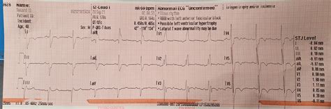 48 Yom Extreme Axis Deviation R Ecg
