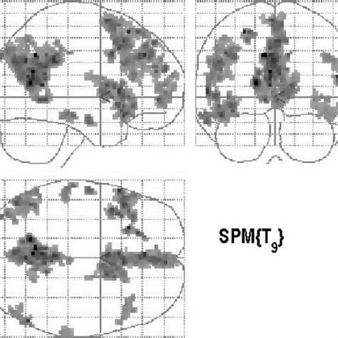 Significant Activation Foci Displayed On A Statistical Parametric Map Download Scientific