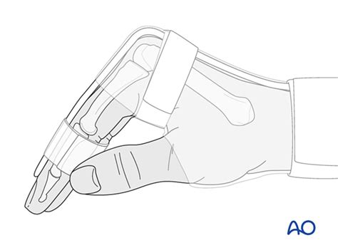 Volar Plate Reattachment For Volar Plate Avulsion Of The Proximal End