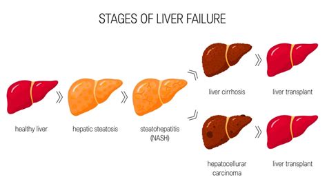 우루사 100mg 가격 효능 200mg 차이