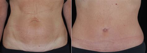 Tummy Tuck Belly Button Belly Button Plastic Surgery Turns Outties