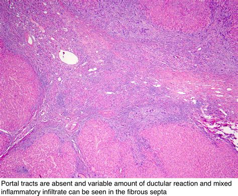 Pathology Outlines Focal Nodular Hyperplasia