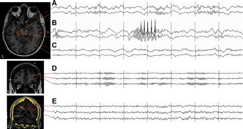 Interpretation Of The Intracranial Stereoelectroencephalography Signal