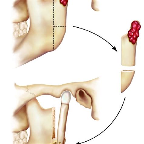 Diagram Of Condylar Reconstruction A Vertical Split Ramus Osteotomy To