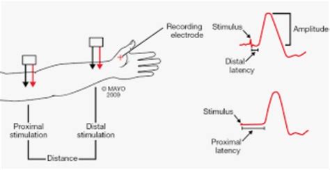 Motor Nerve Conduction