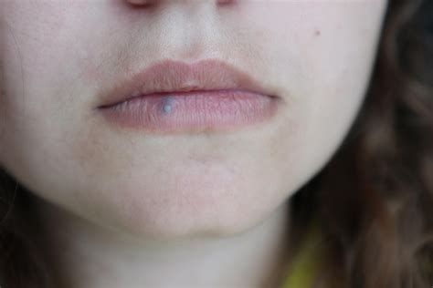 Cherry Angioma On Upper Lip