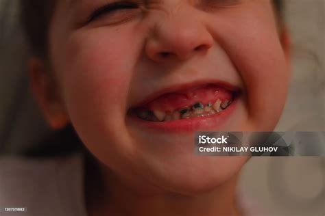 어린 소녀는 깨진 이빨을 보여줍니다 깨진 썩은 이빨을 가진 소녀 큰 초상화 앞에서 볼 수 있습니다 치아 보충재에 대한 스톡 사진