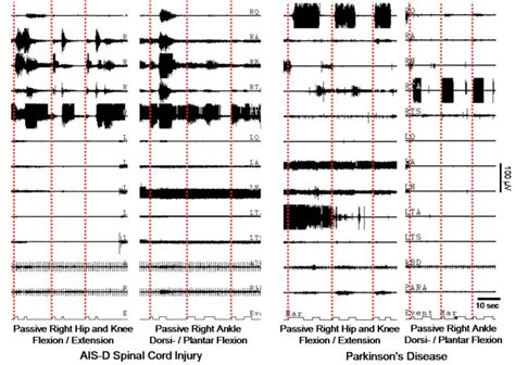Passive Movement Complex Responses From Incomplete Sci And Shortening