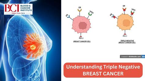 Understanding Triple Negative Breast Cancer Diagnosis And Treatment