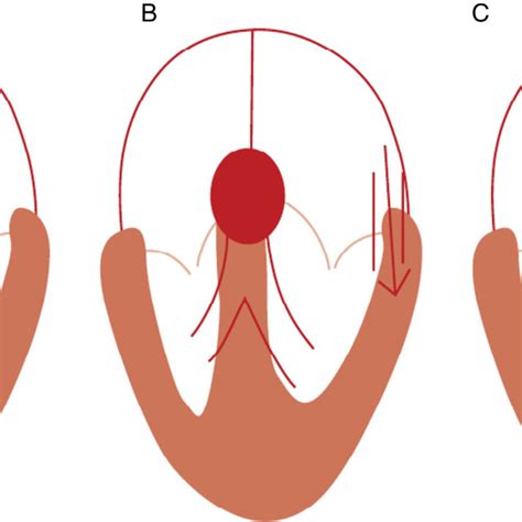 Mecanismos Para Taquicardia De QRS Largos A TSV Com Bloqueio De Download Scientific Diagram