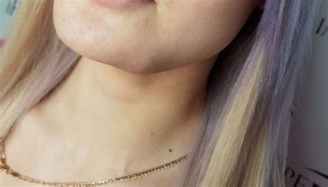 Lump On Jaw Bone Causes Symptoms And Treatment Options For Movable