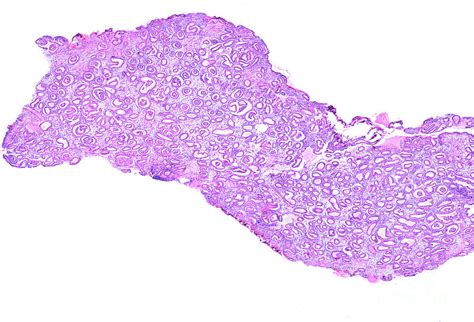 Endometrial Hyperplasia Endometrial Ablasion