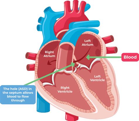 What Is Ebsteins Anomaly Lagans Foundation