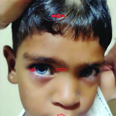 A And B Diffuse Retinal Hypopigmentation Leading To Exposure Of