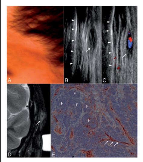 Figure 1 From Vasculitis Of The Temporal Artery In A Young Woman