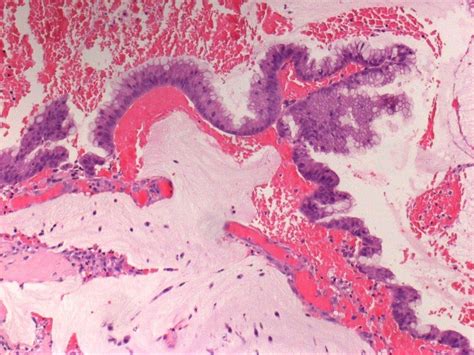 Appendiceal Mucocele Eurorad