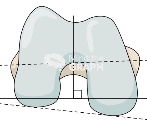 Measured Resection Knee