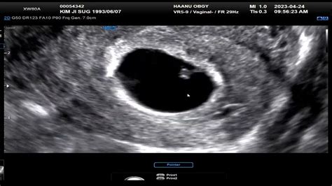 임신 6주차3일 태아는 어떻게 생겼을까심장소리 들어볼까 Youtube