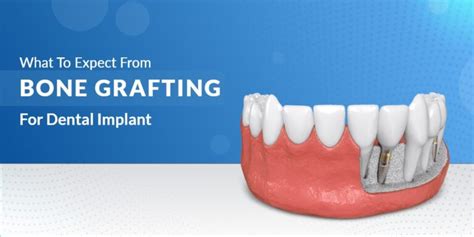 What To Expect From Bone Grafting For Dental Implant La Dental