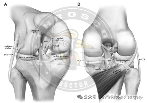 手术理念｜后交叉韧带重建时在什么角度下固定最佳？ 知乎