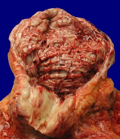 Prostate Nodular Hyperplasia