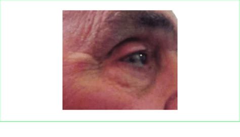 Sclera Pigmentation Download Scientific Diagram
