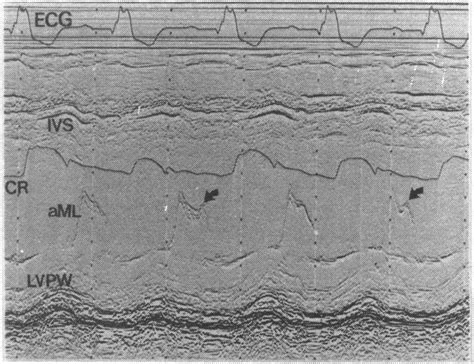 M Mode Echocardiogram Ofcase 2 With Simultaneous Carotid Pulse