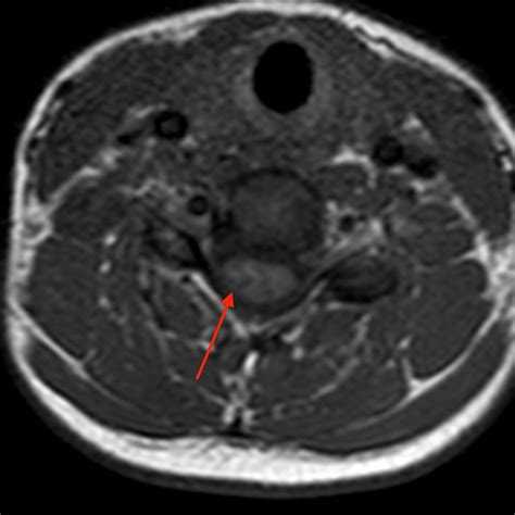 Spinal Cord Cavernous Malformation Radsource