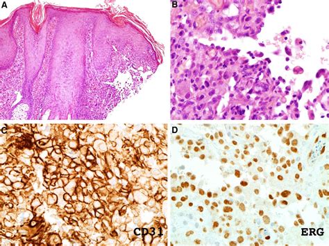 Dramatic Response Of Metastatic Cutaneous Angiosarcoma To An Immune