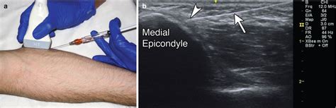 Lateral Epicondyle Injection Medial Epicondyle Injection Background