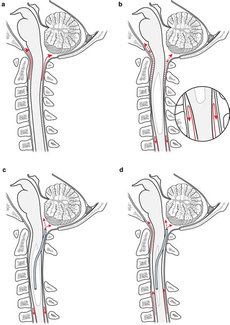 A Normal Cerebrospinal Fluid CSF Flow In The Spinal Canal B In Case Download Scientific