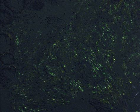 Periorbital Purpura As A Key Diagnostic Clue In Immunoglobulin Light