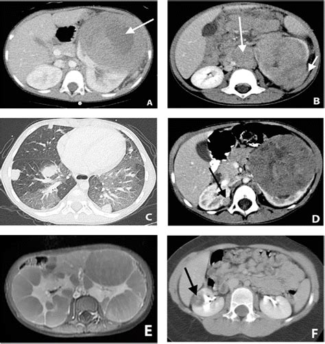 A Large Left Renal Mass In A 4 Year Old Female With Central Areas Of
