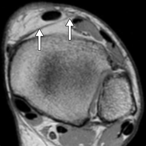 Medial Ankle Tendons Axial