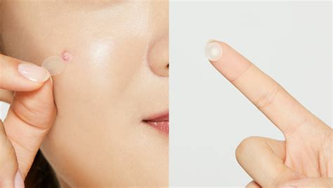 What Are Pimple Patches Beauty Barn Blog