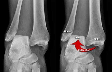 Tibiotalar Joint Dislocation