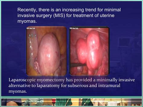 Myomectomy Laparoscopic Vs Laparotomy 2 Ppt