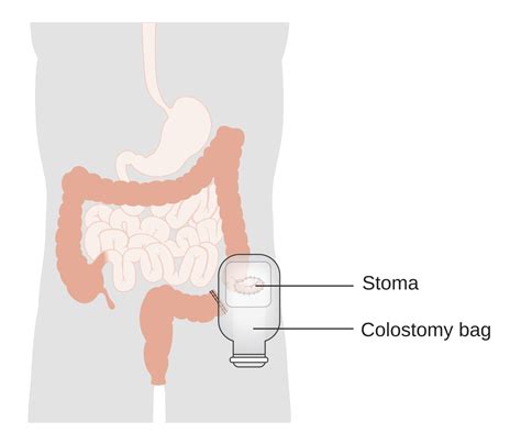 Ileostomy Diagram Wiring Diagram Pictures