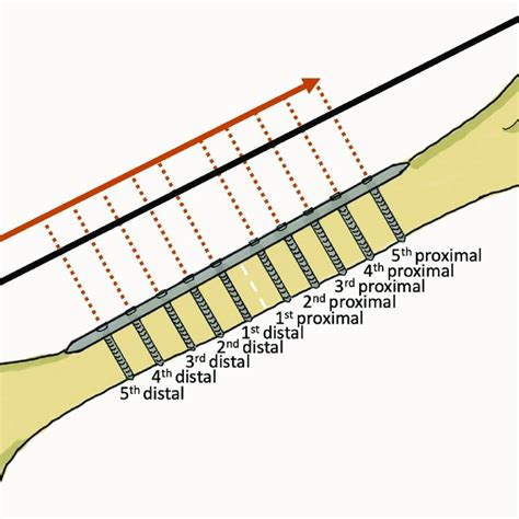 Supinator Muscle Attachment A Distal Attachment Of The Supinator At