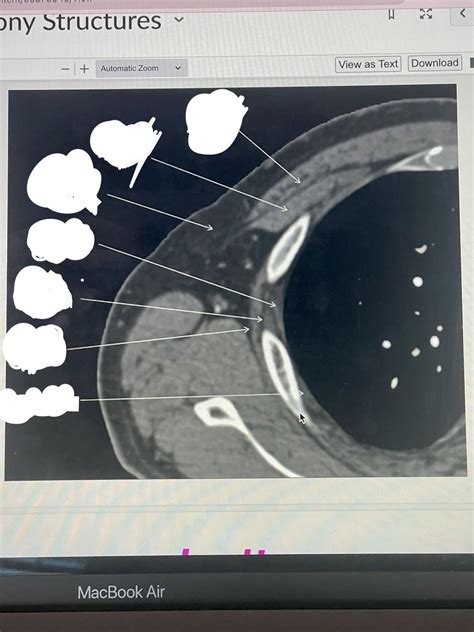 Cross Sectional Module 2 Bony Thorax Ct Muscle Labeling Diagram Quizlet