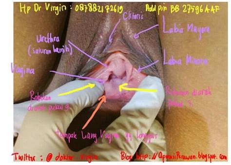 Dokter Virgin On Twitter Ini Perbedaan Antara Hymen Yg Belum Di Operasi Perawan Dan Yg Sdh Di