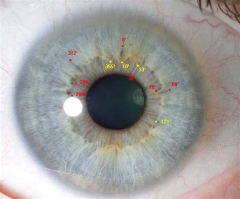 Modern And Multidimensional Iridology Multiple Bridged Linear